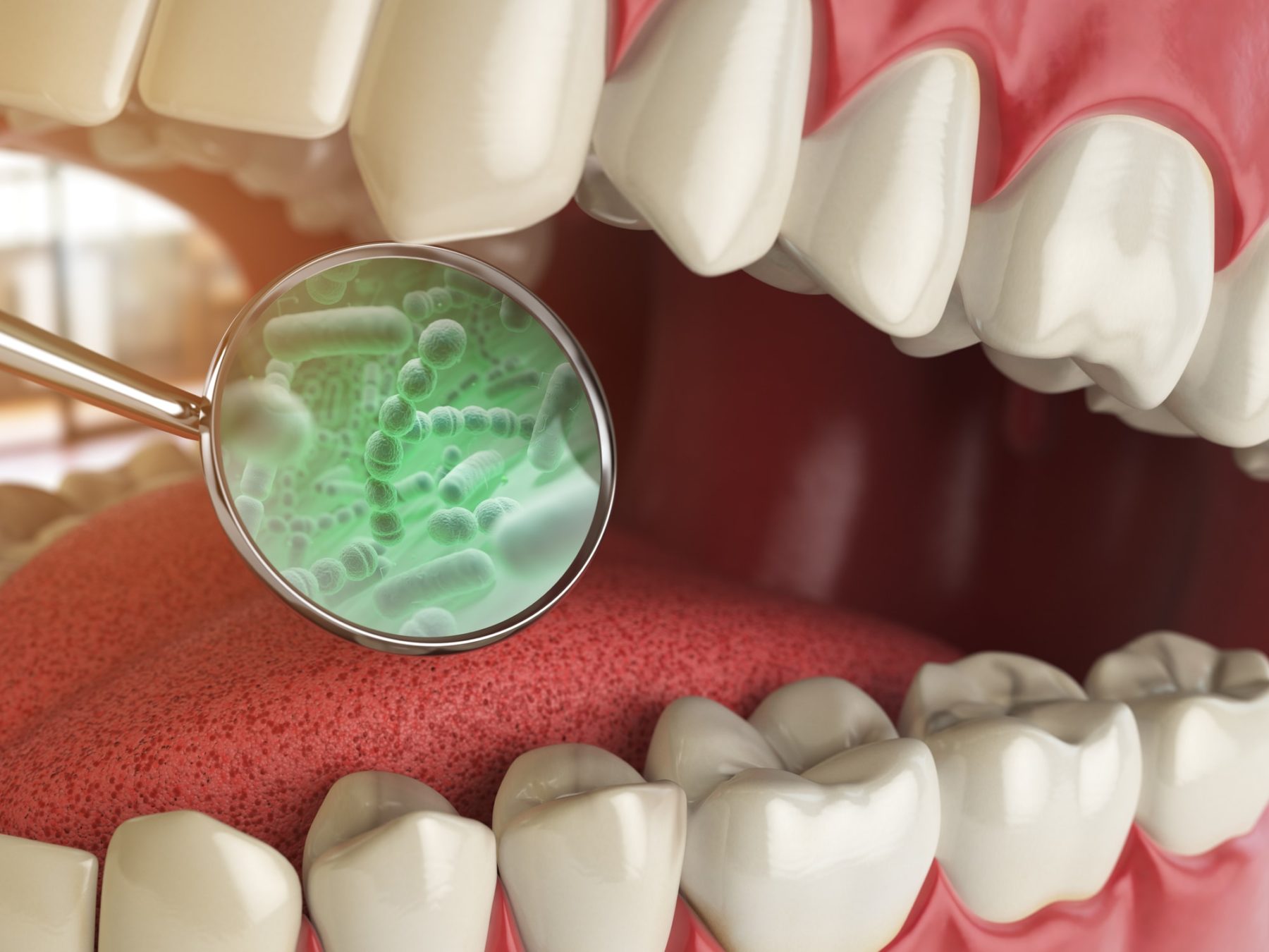Halitosis (Bad Breath) Treatment - The Dentist of Siouxland